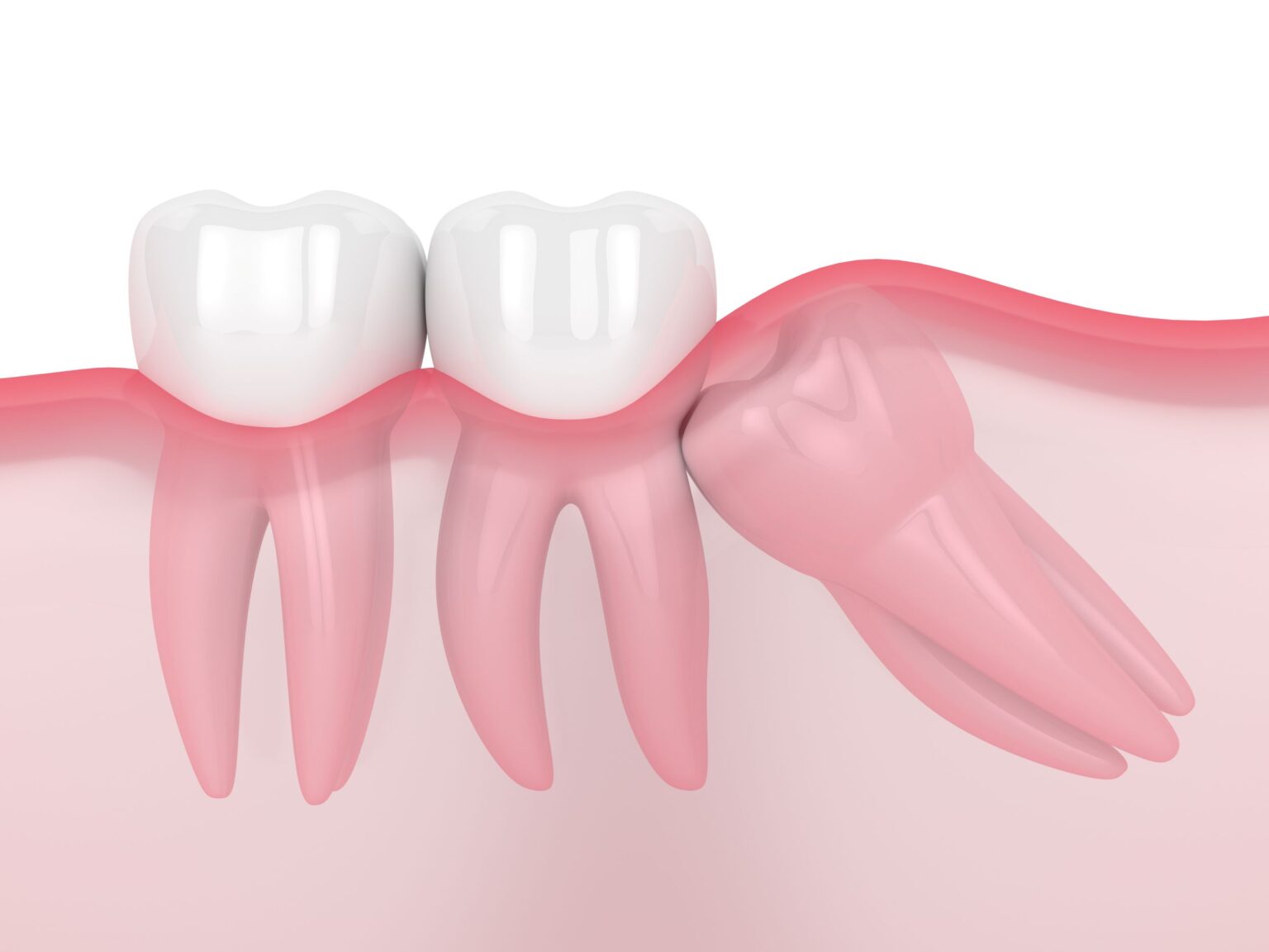 Sensible Smiles: Why Extract Healthy Wisdom Teeth? | Coombs, Ross ...